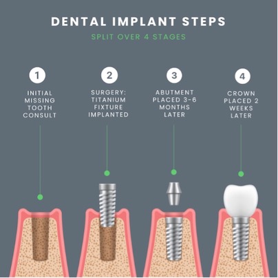 Dental Implant Procedure Everything You Need To Know The Kensington