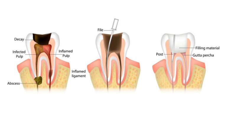Root Canal Procedure: Everything you need to know - The Kensington Dentist