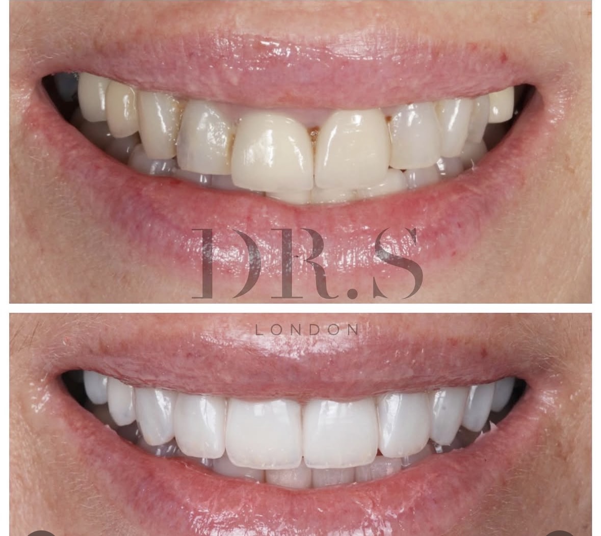 Choosing Composite Bonding vs Veneers - The Kensington Dentist